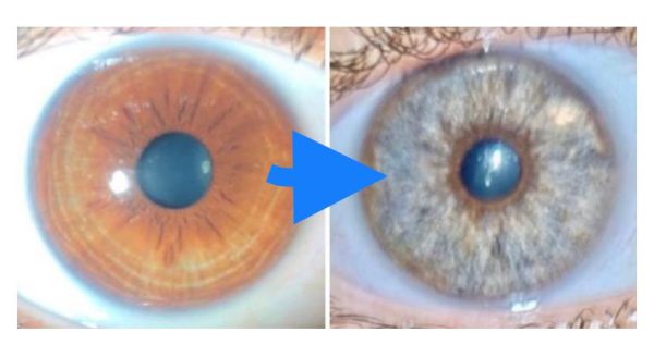 Images of before and after the treatment of eye color change - Eyecos ...