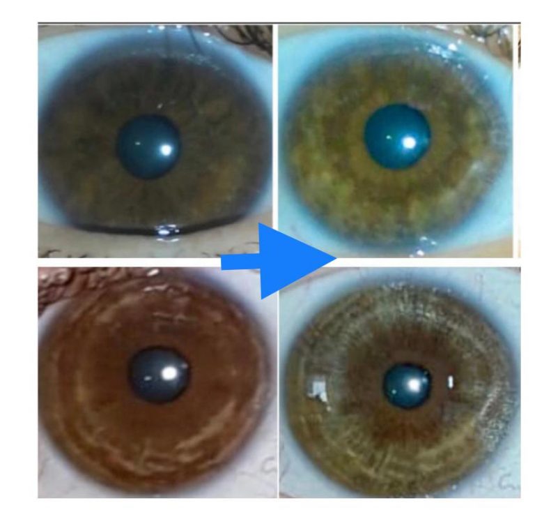 Images of before and after the treatment of eye color change - Eyecos ...