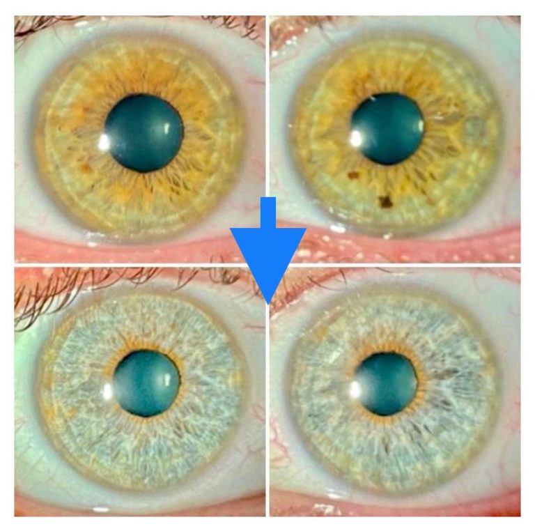 Images of before and after the treatment of eye color change - Eyecos ...