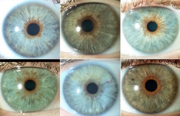 Eye Color Change: Keratopigmentation versus laser depigmentation ...