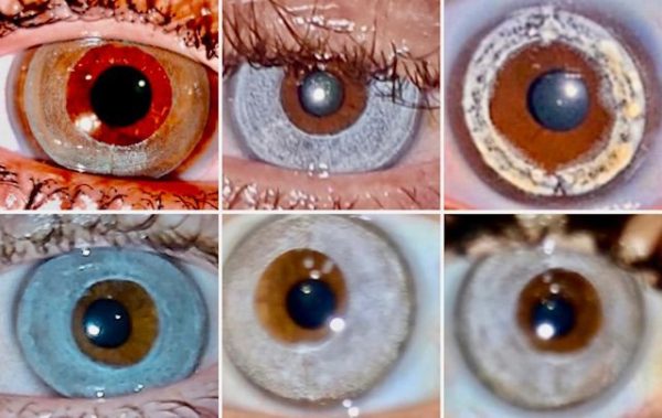 NewEyes Laser: the true & safe eye color change - Clínica Eyecos ...