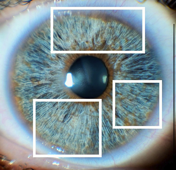 The role of collagen in eye color change - Clínica Eyecos - Cambio ...