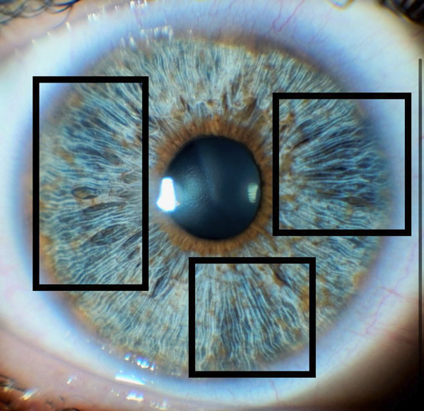 The role of collagen in eye color change - Clínica Eyecos - Cambio ...